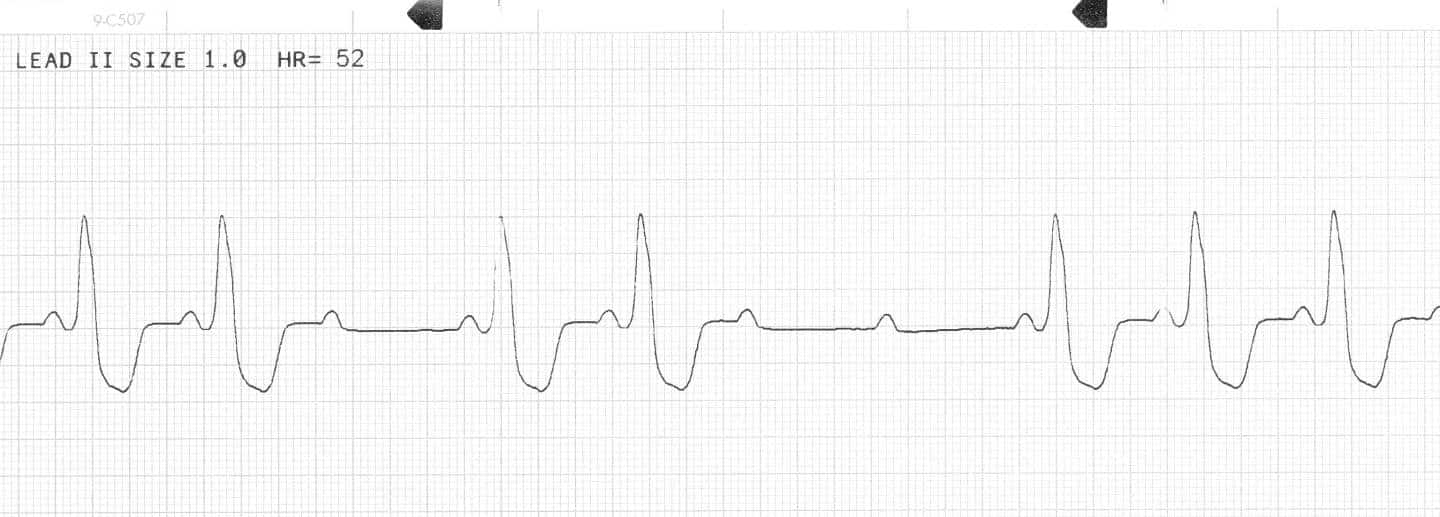 Heart Blocks - ALS Now