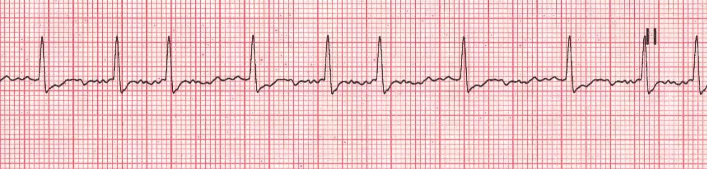 Atrial Arrhythmias - ALS Now