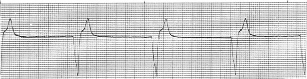 Idioventricular Rhythm - ALS Now