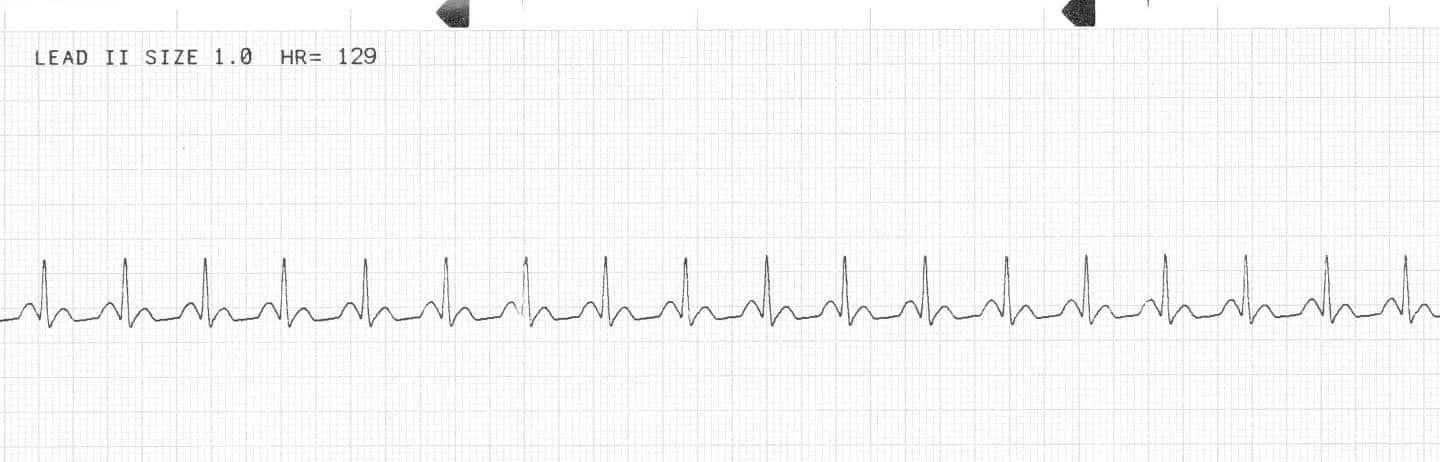 Sinus Rhythms - Paediatric - ALS Now
