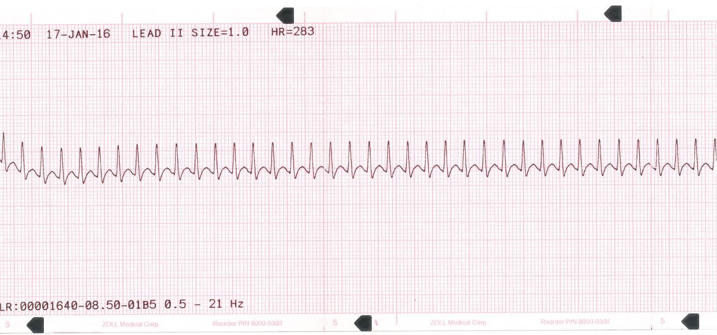 Supraventricular Tachycardia (SVT) - ALS Now