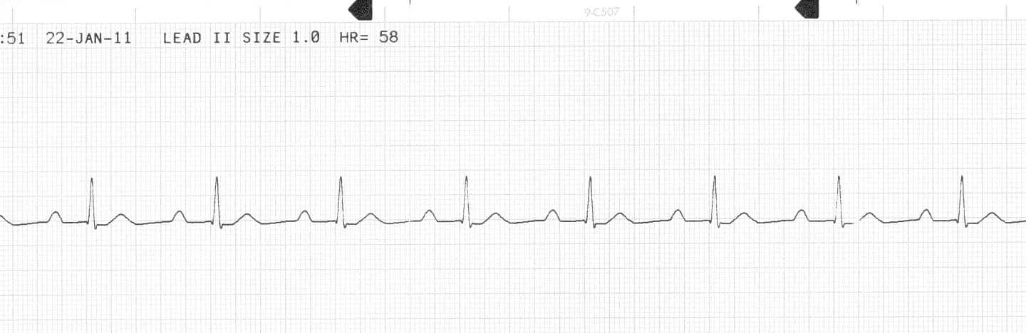 Heart Blocks - ALS Now