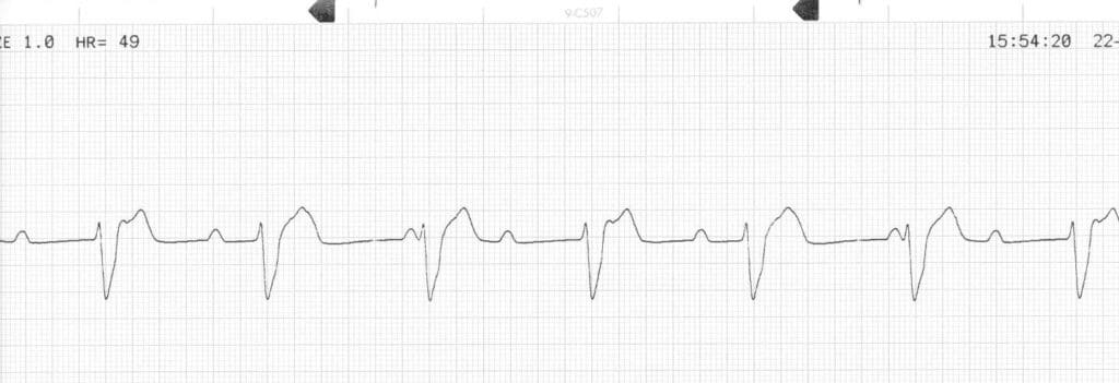 Heart Blocks - ALS Now