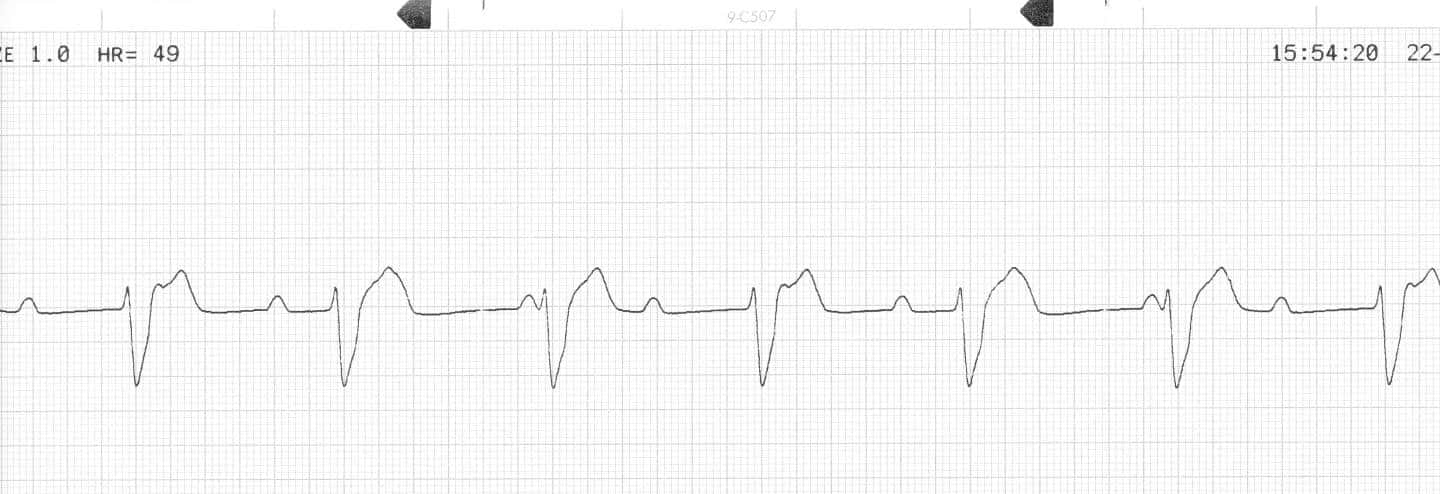 Heart Blocks - ALS Now