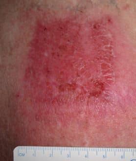 Delivery of Shock - ALS Now