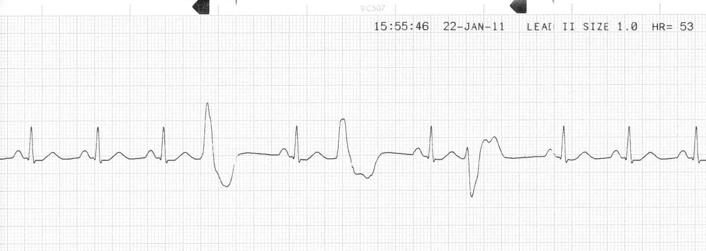 Premature Ventricular Contractions - ALS Now