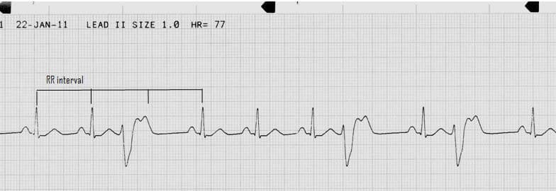 Premature Ventricular Contractions - ALS Now
