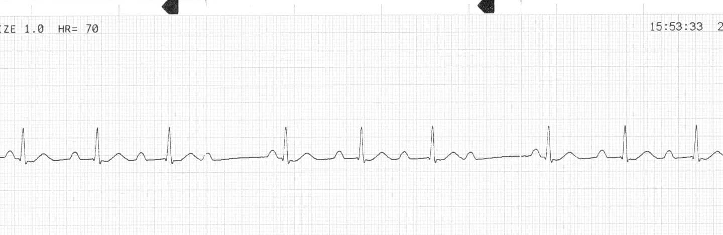 Heart Blocks - ALS Now